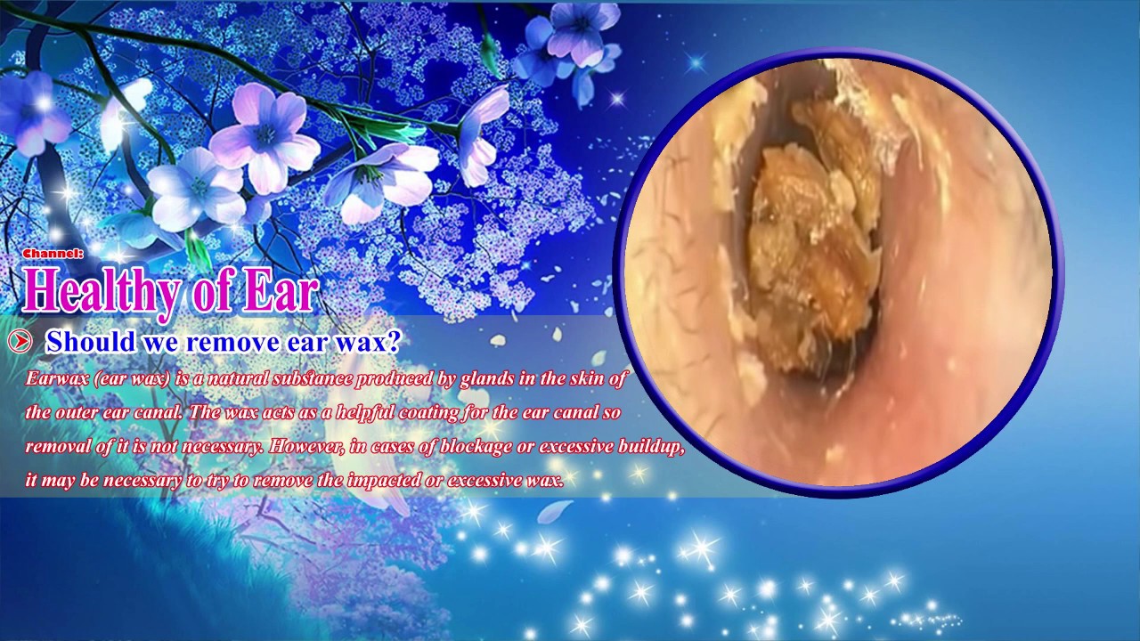 Rock solid ear wax removal compilation inc rock #01 - YouTube