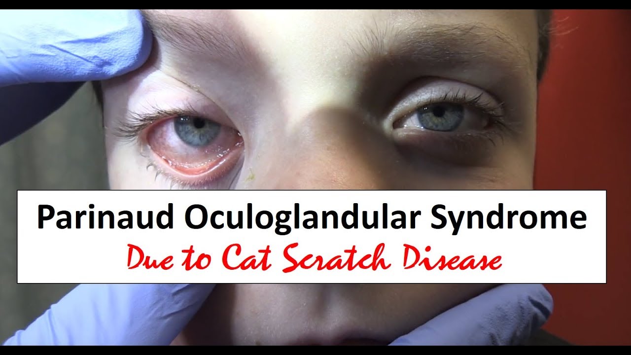 Sindrome Oculoglandular De Parinaud Case Series Of Parinaud's