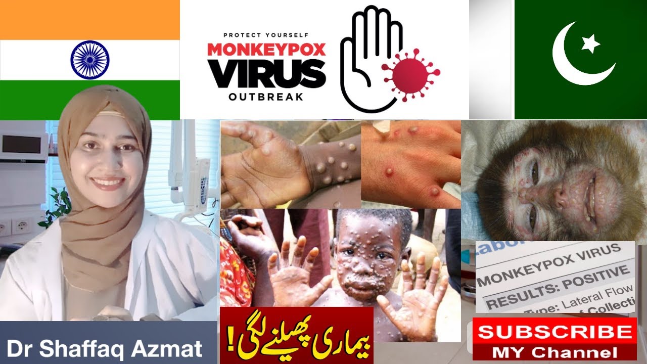Monkeypox virus | Monkeypox Virus Kya hai | monkeypox symptoms - Explained by Dr Shaffaq Azmat ...