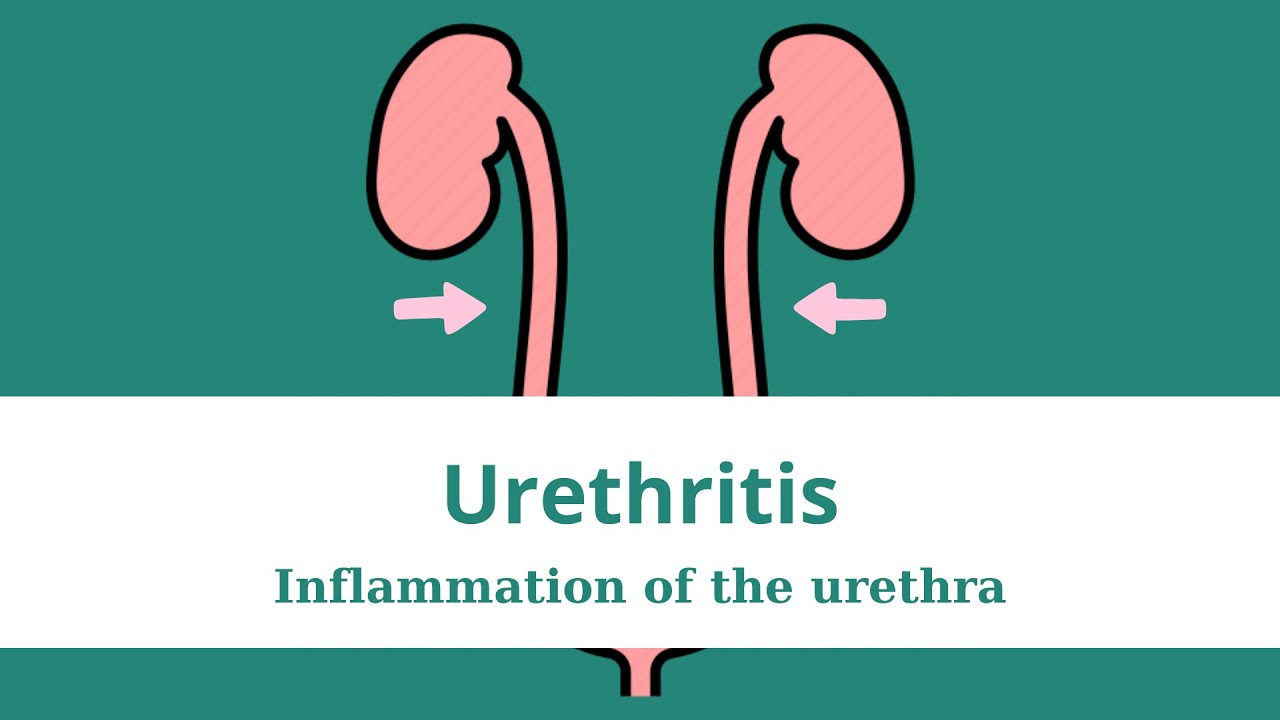 #urethritis : Causes, Symptoms, and Effective Treatment Options - YouTube