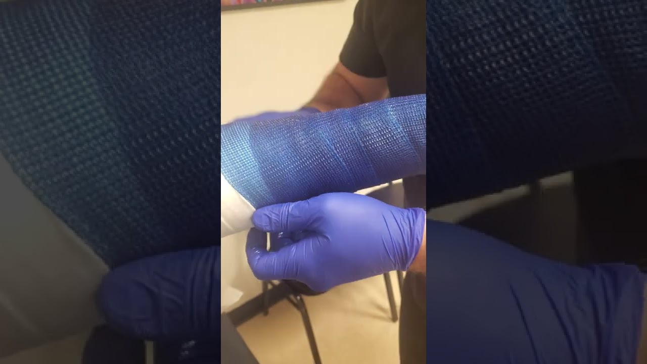 How to Make a Fiberglass Muenster Cast - YouTube