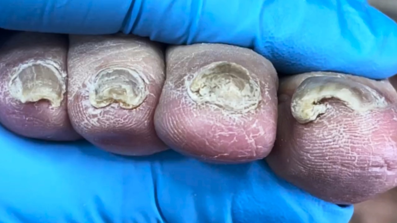 Amazing Hook Nails! Cut Them All Out!【Pedicure Master Lin Jun】 - YouTube