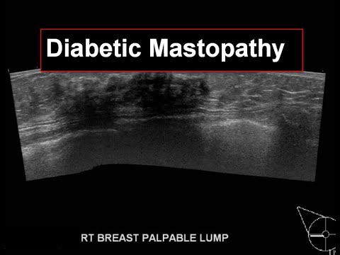 Diabetic Mastopathy on High Resolution Breast Ultrasound - YouTube