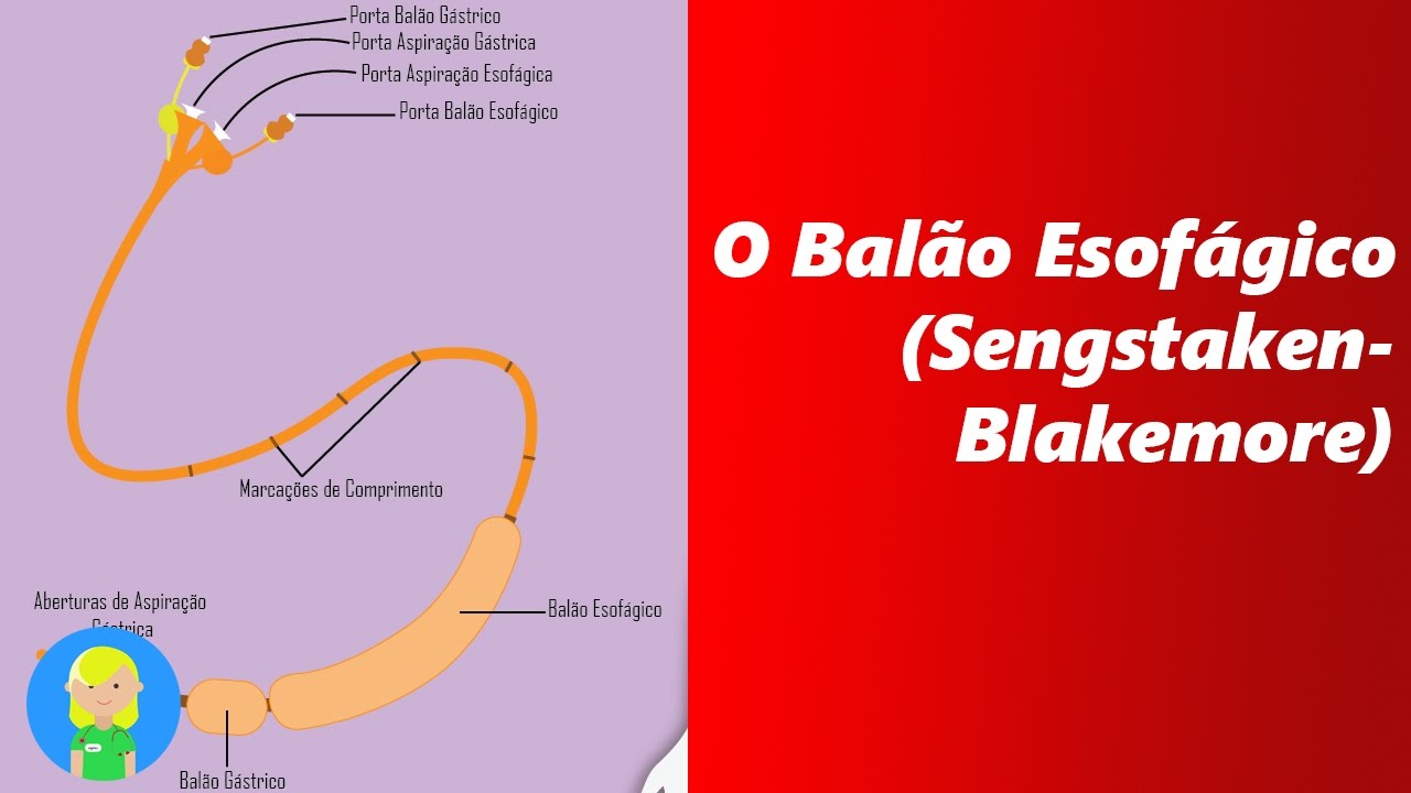 O Balão Esofágico - YouTube
