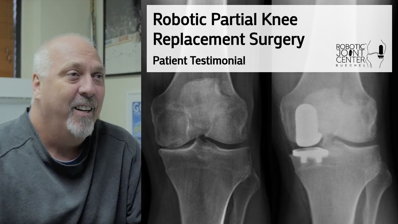 Paul Partial Robotic Knee Replacement Surgery Testimonial | Frederick ...