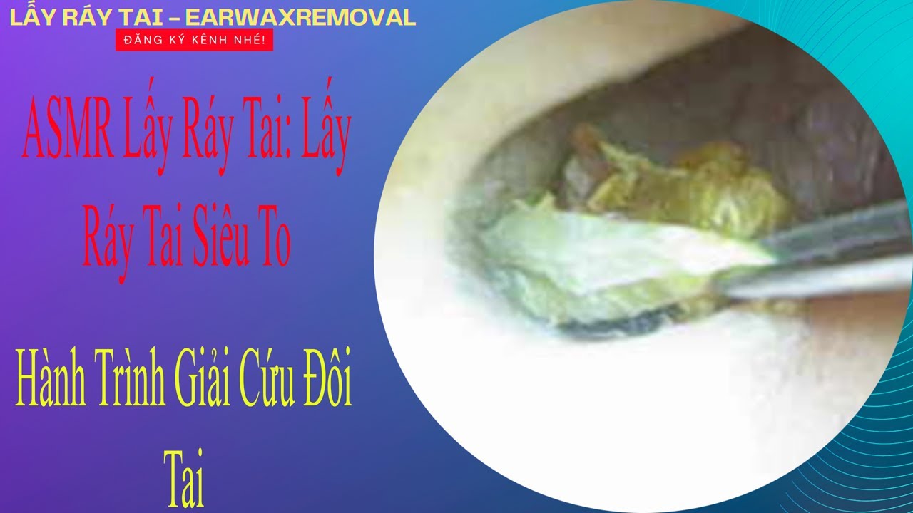 ASMR LẤY RÁY TAI: LẤY RÁY TAI SIÊU TO – HÀNH TRÌNH GIẢI CỨU ĐÔI TAI 😱 ...