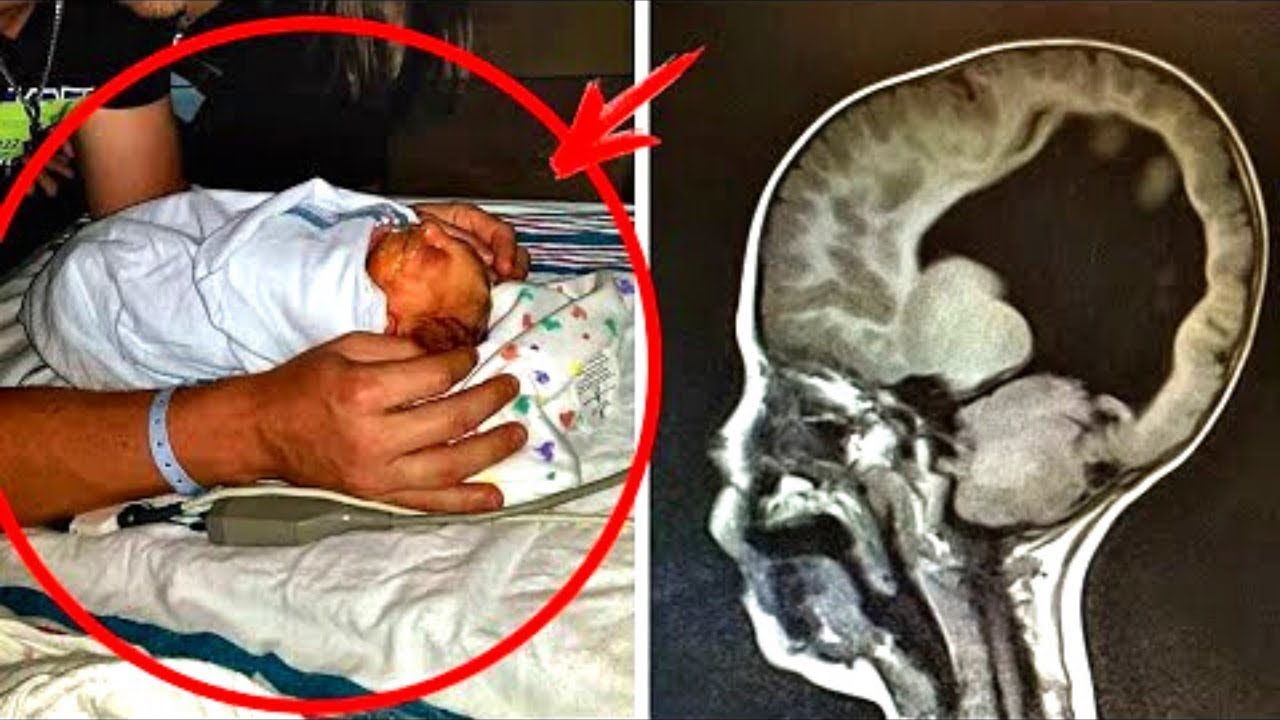 This Child Was Born Without a Brain But What Happened After 3 Years Was ...