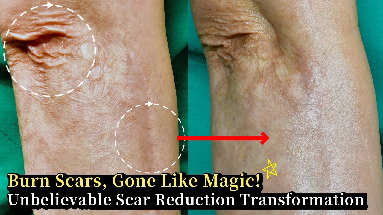 We clearly removed thick burn scars and sunken scars from reduction ...