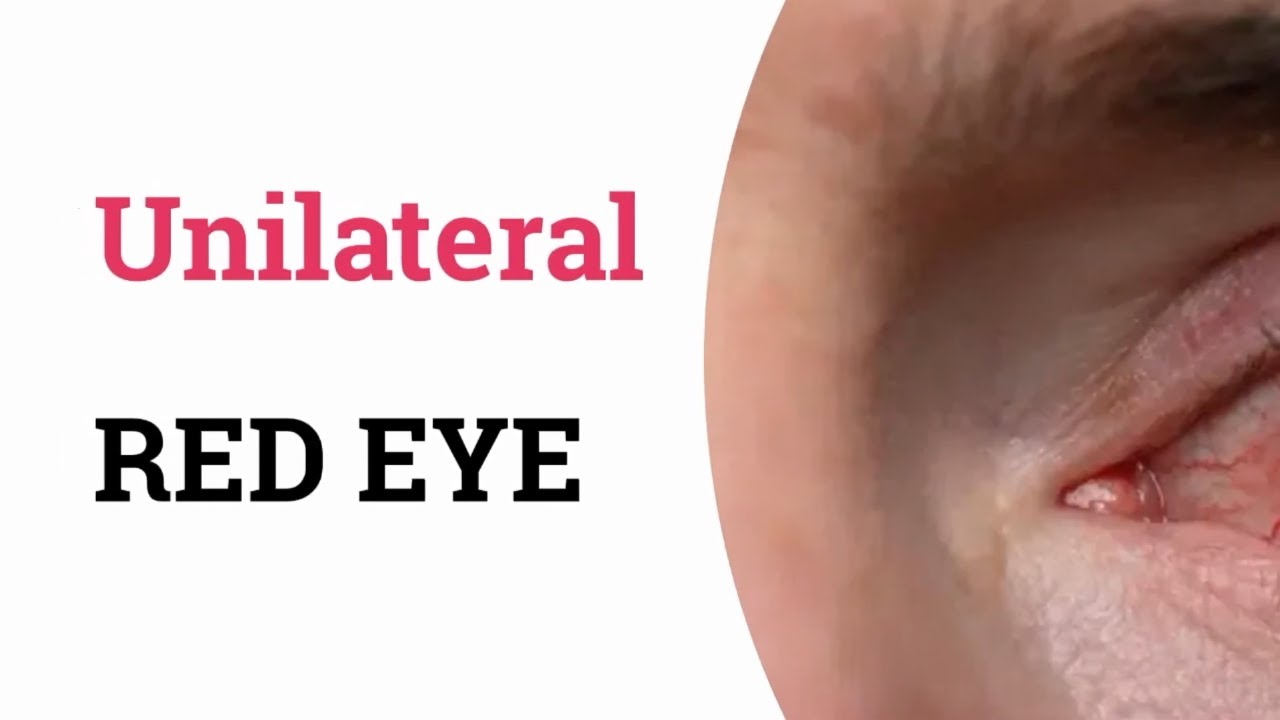 Unilateral Red Eye - YouTube
