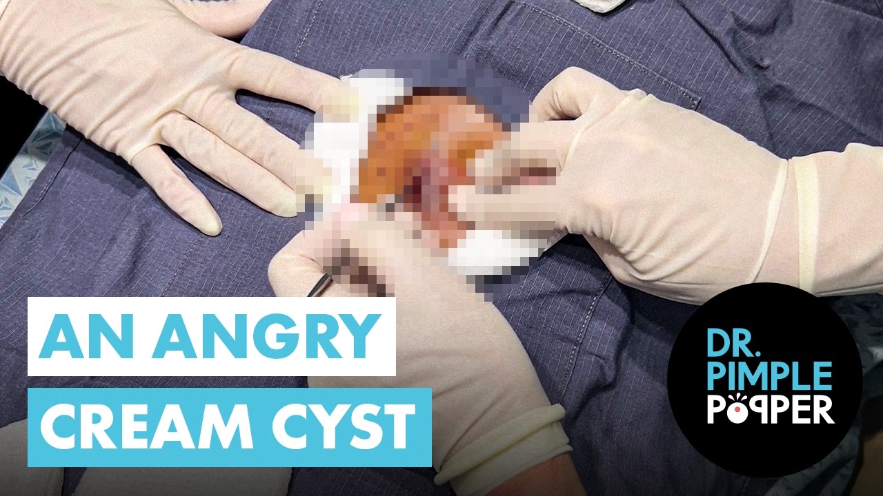 An Angry Cream Cyst - YouTube
