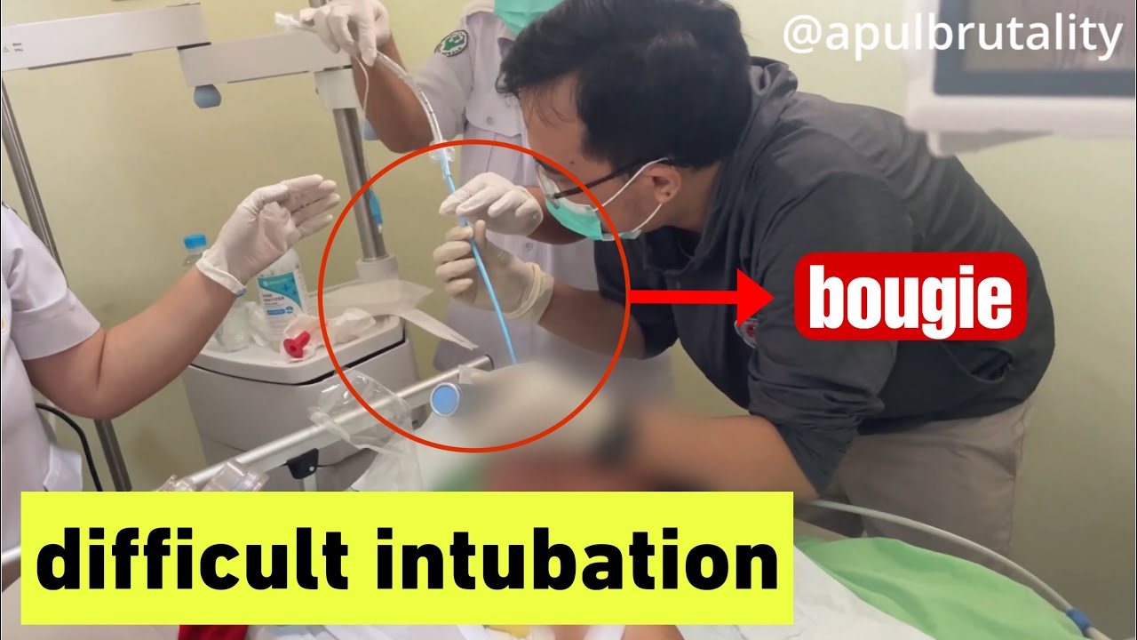Bougie assisted endotracheal intubation - difficult intubation - YouTube