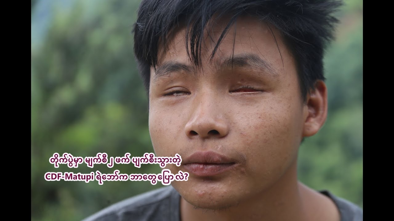 တိုက်ပွဲမှာ မျက်စီ ၂ ဖက် ပျက်စီးသွားတဲ့ Cdf Matupi ရဲဘော်က ဘာတွေပြောလဲ Youtube