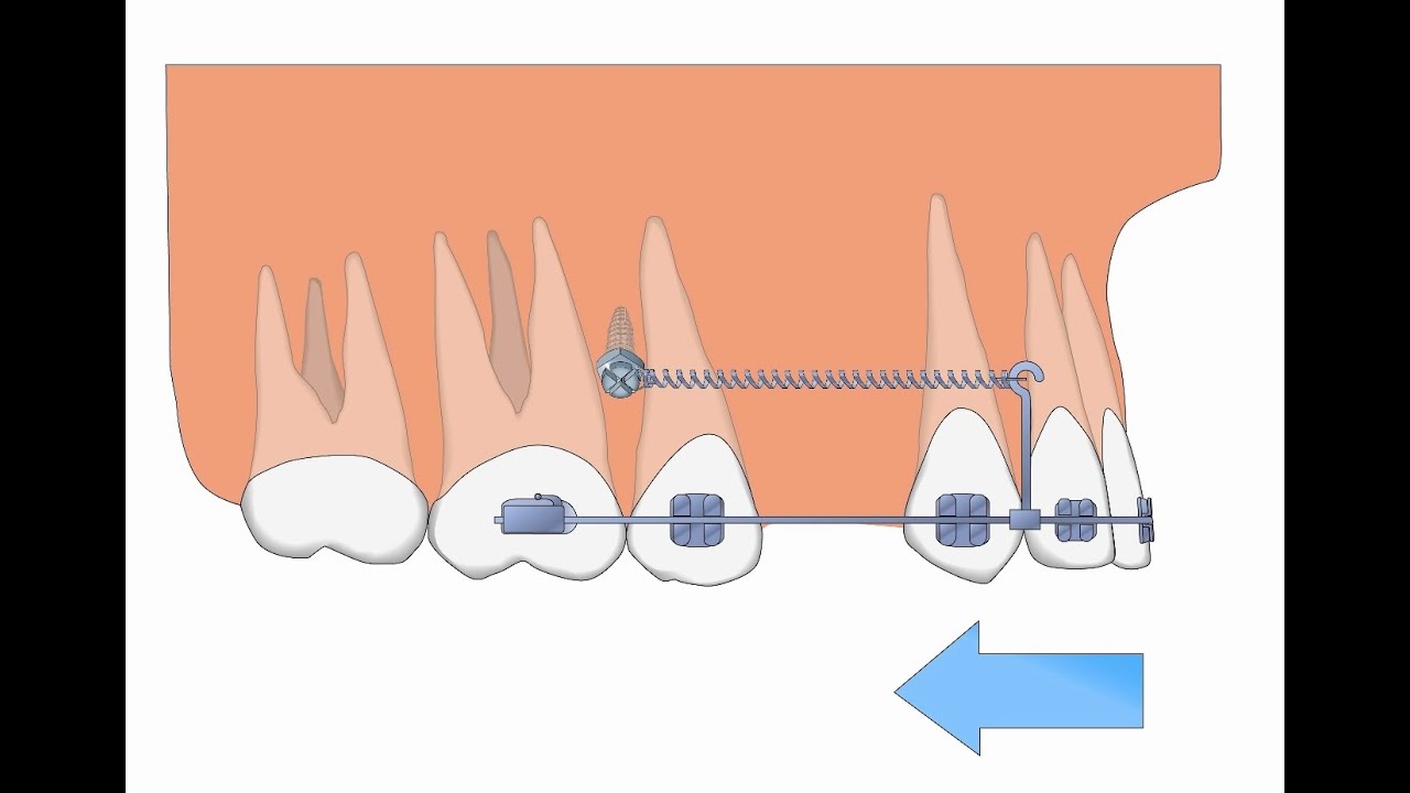 Miniscrews in orthodontics - Infographic educational video for patients ...