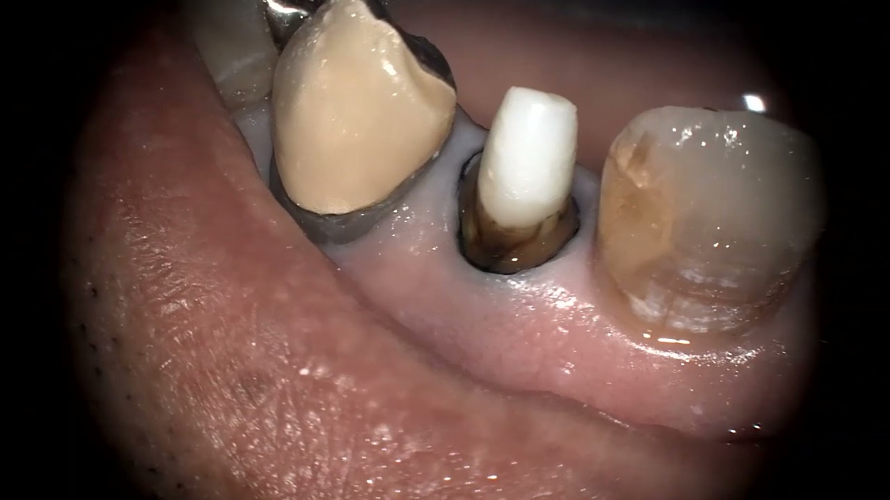 Preparation / subgingival - YouTube