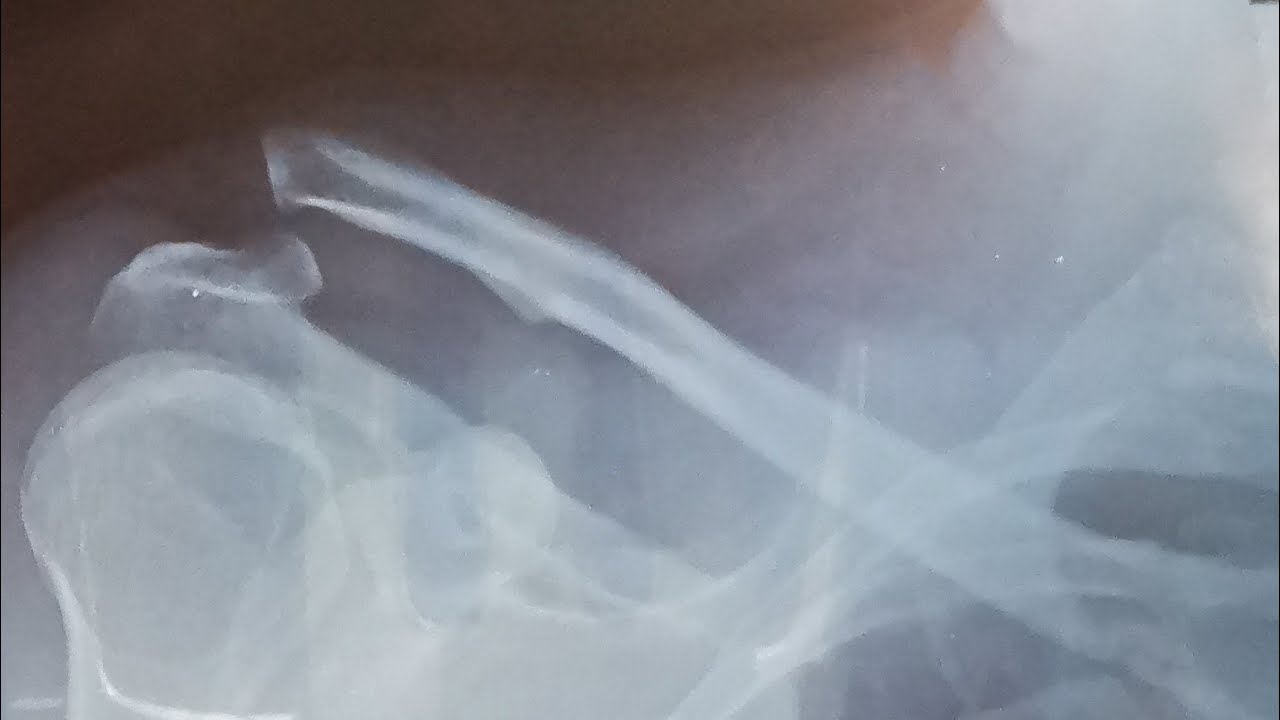 Pengalaman Tulang Selangka Terkehel Tanpa Pembedahan: Grade 3 ACJ ...