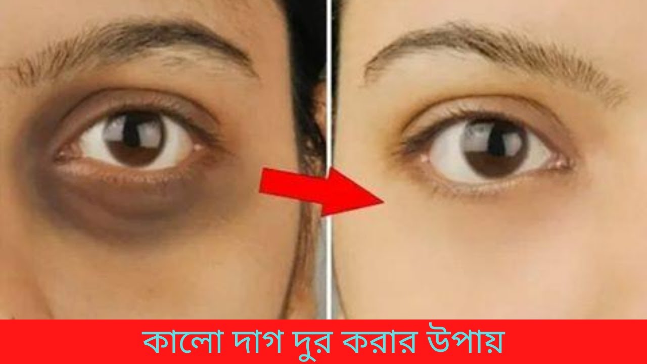 Kalo Dag Dur Korar Upay - কালো দাগ দুর করার উপায় - YouTube