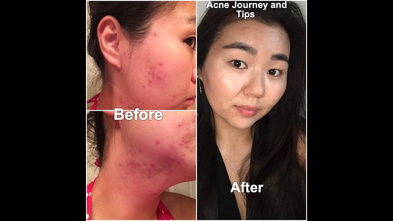 Acne on Asian Skin; Acne Journey and Treatment - YouTube