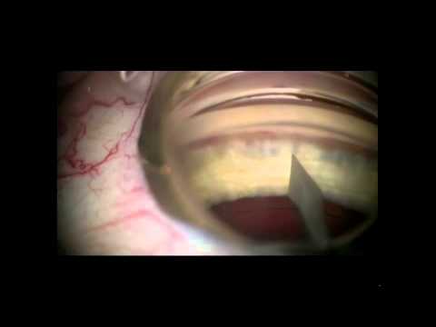 Ab Interno Canaloplasty (ABiC) Omar F Almallah, MD - YouTube