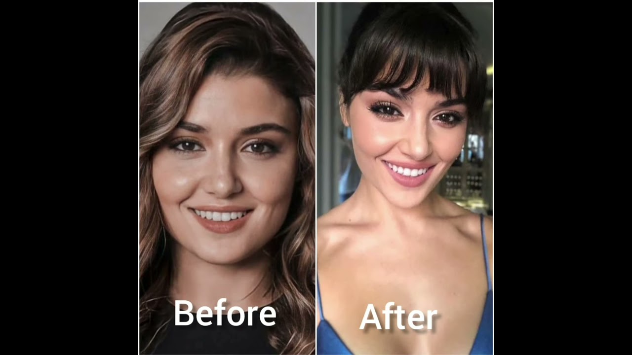 Turkish Actress Hande Ercel Before And After Plastic Surgery Then And My Xxx Hot Girl
