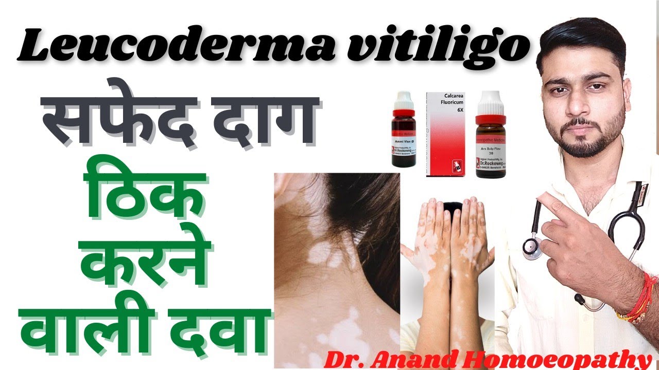 leucoderma || vitiligo ll सफेद दाग ठिक करने के उपाय || safed daag ka ilaj - YouTube