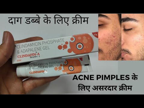 CLINDAFIN A GEL Ke Fayde| दाग डब्बे पिंपल्स के लिए क्लिंडाफिन A क्रीम # ...