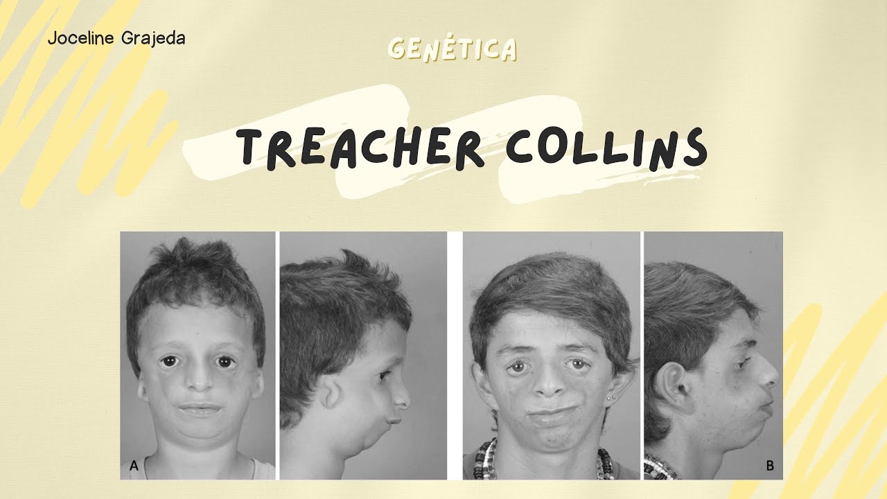 Treacher Collins | Genereviews - YouTube