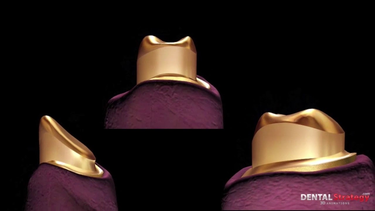 062 - Telescopic crowns - YouTube