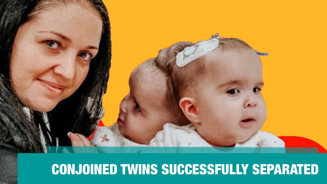 Real Conjoined Twins- Rarer than One in a Million. Separating. Abigail ...