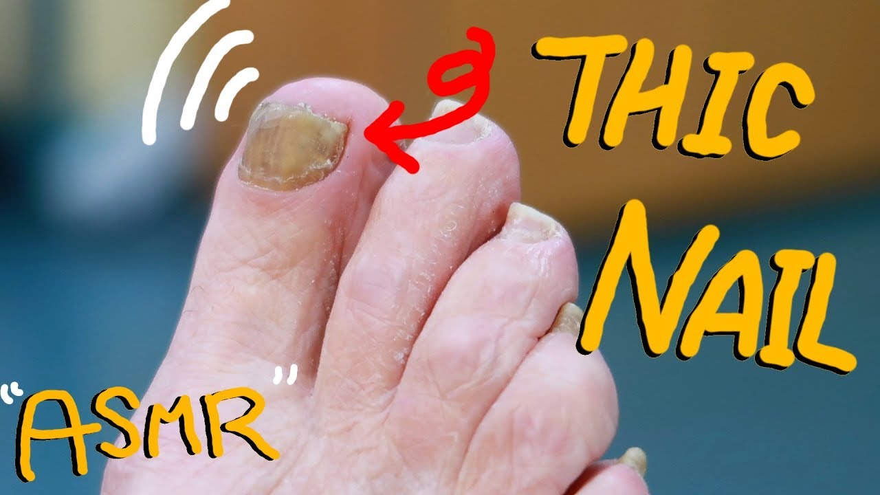 THICK & GUNKY Toenail removal; Blessing Her Toenail - YouTube