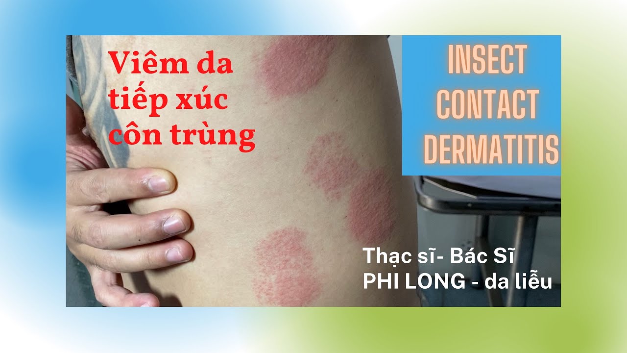 Insect contact dermatitis - YouTube