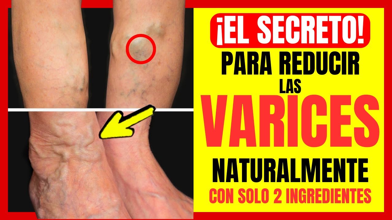 🔴 COMO ELIMINAR LAS VARICES DE LAS PIERNAS CON 2 INGREDIENTES (MIRA ...