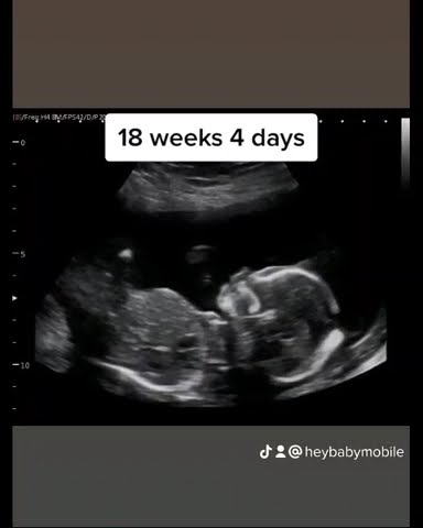 Baby Profile on 2D Ultrasound at 18 Weeks 4 Days Pregnant - YouTube