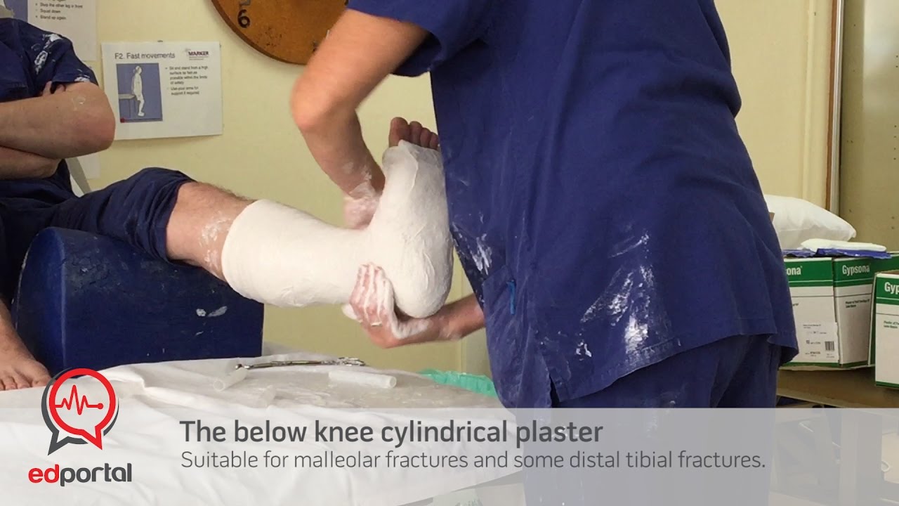 Below knee cylindrical plaster - YouTube