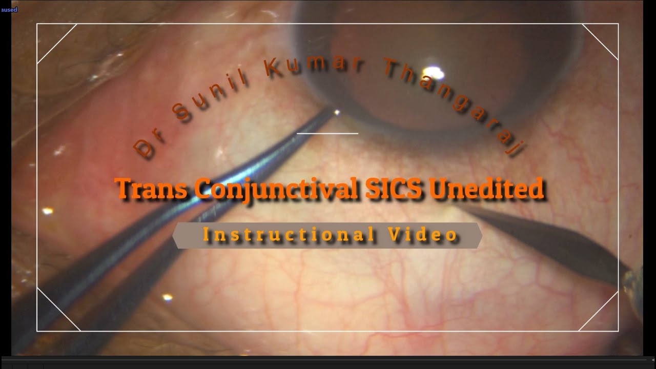 Trans conjunctival small incision cataract surgery unedited an ...