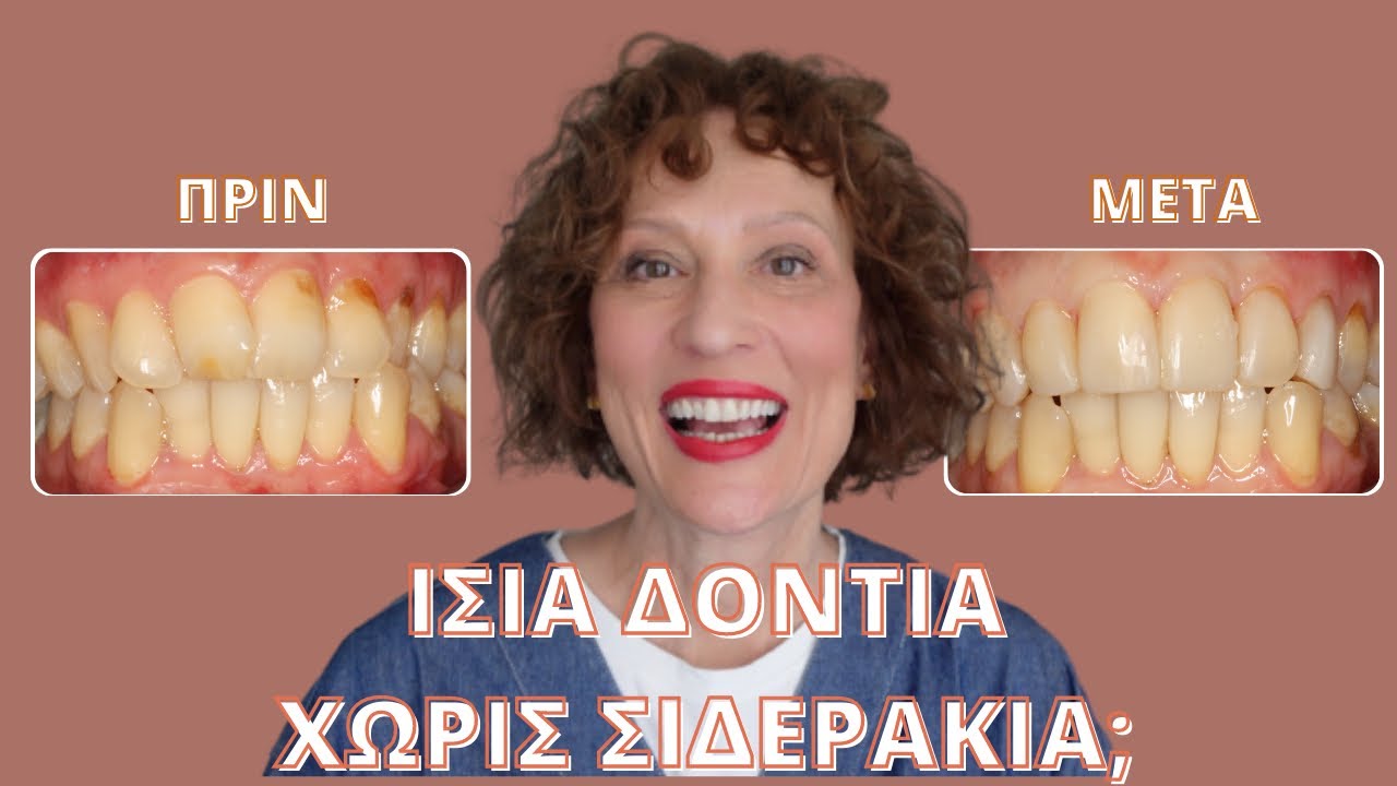 Ίσια δόντια, με όψεις ρητίνης! Γίνεται ; - YouTube