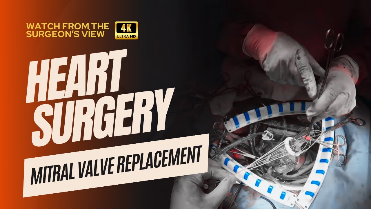 Mitral Valve Replacement – Open Heart Surgery | MVR Procedure (Surgeon ...