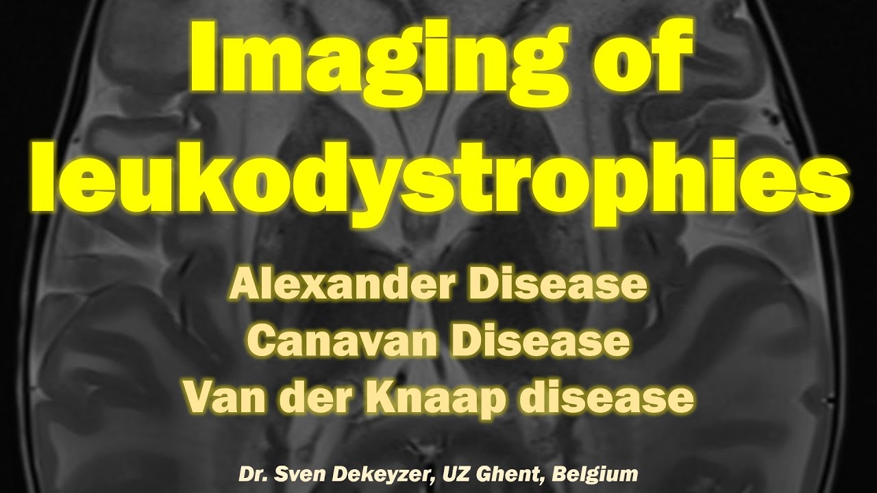 Imaging of Leukodystrophies (part 1): Alexander disease, Canavan ...