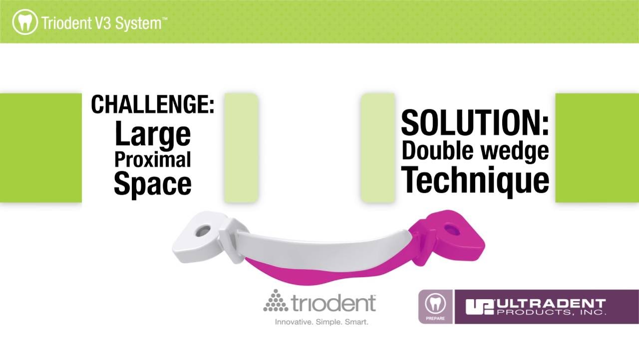 Triodent V3 System: Double Wedge technique - YouTube