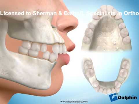 Four bicuspid Extraction Upper 1st Lower 2nd - YouTube