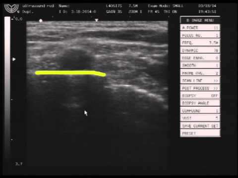 Supraclavicular fossa scan - YouTube