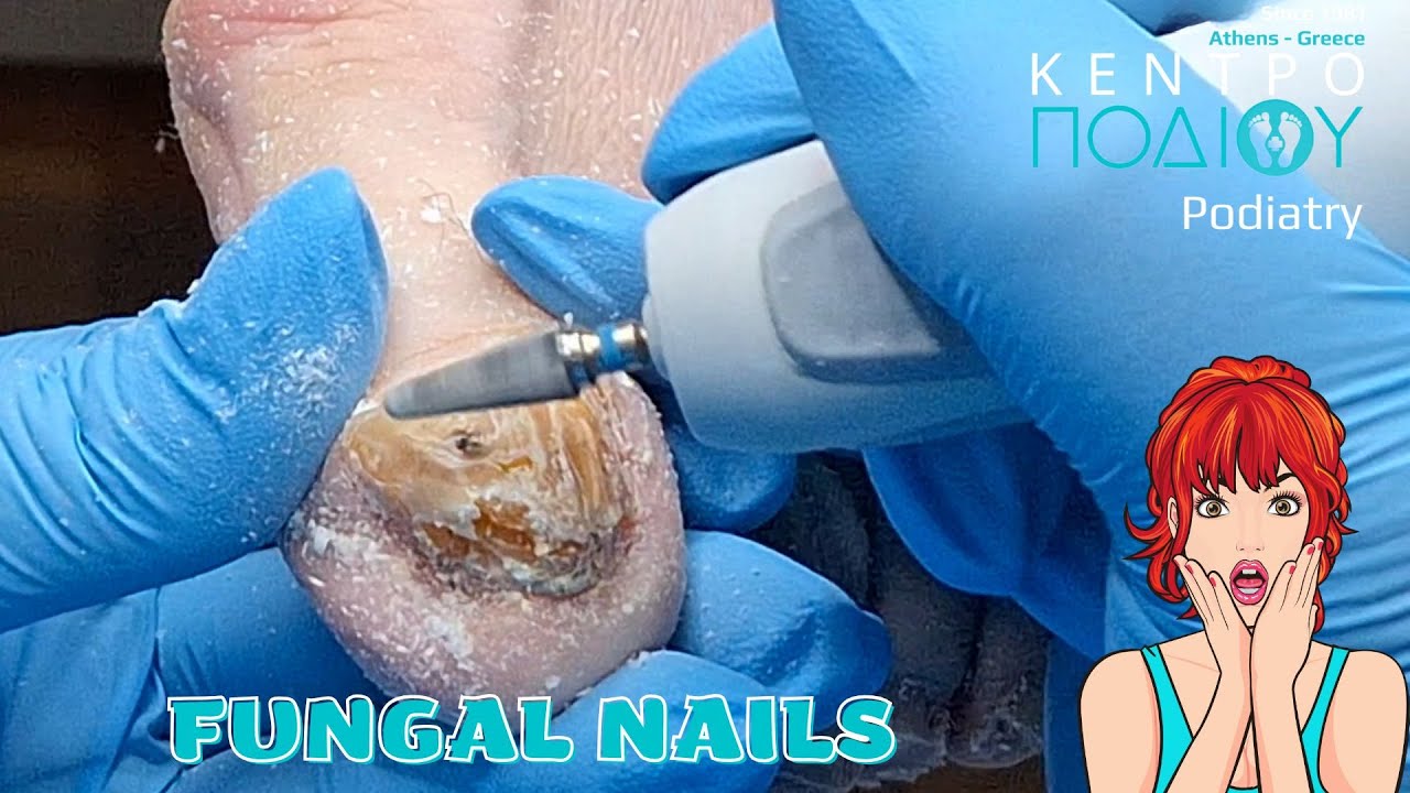 Nails Treatment|Fungus nails #kentropodiou #κεντροποδιου #podologos # ...