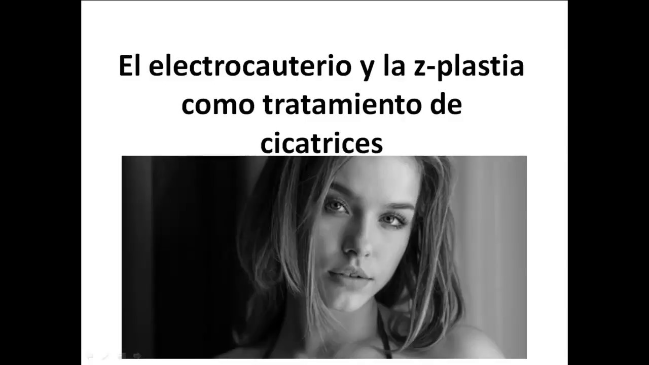 El electrocauterio y la z-plastia como tratamiento de cicatrices - YouTube