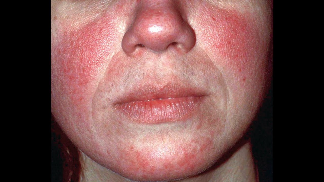 ROSACEA: Everything you need to know: Treatment-Causes- What is Rosacea ...