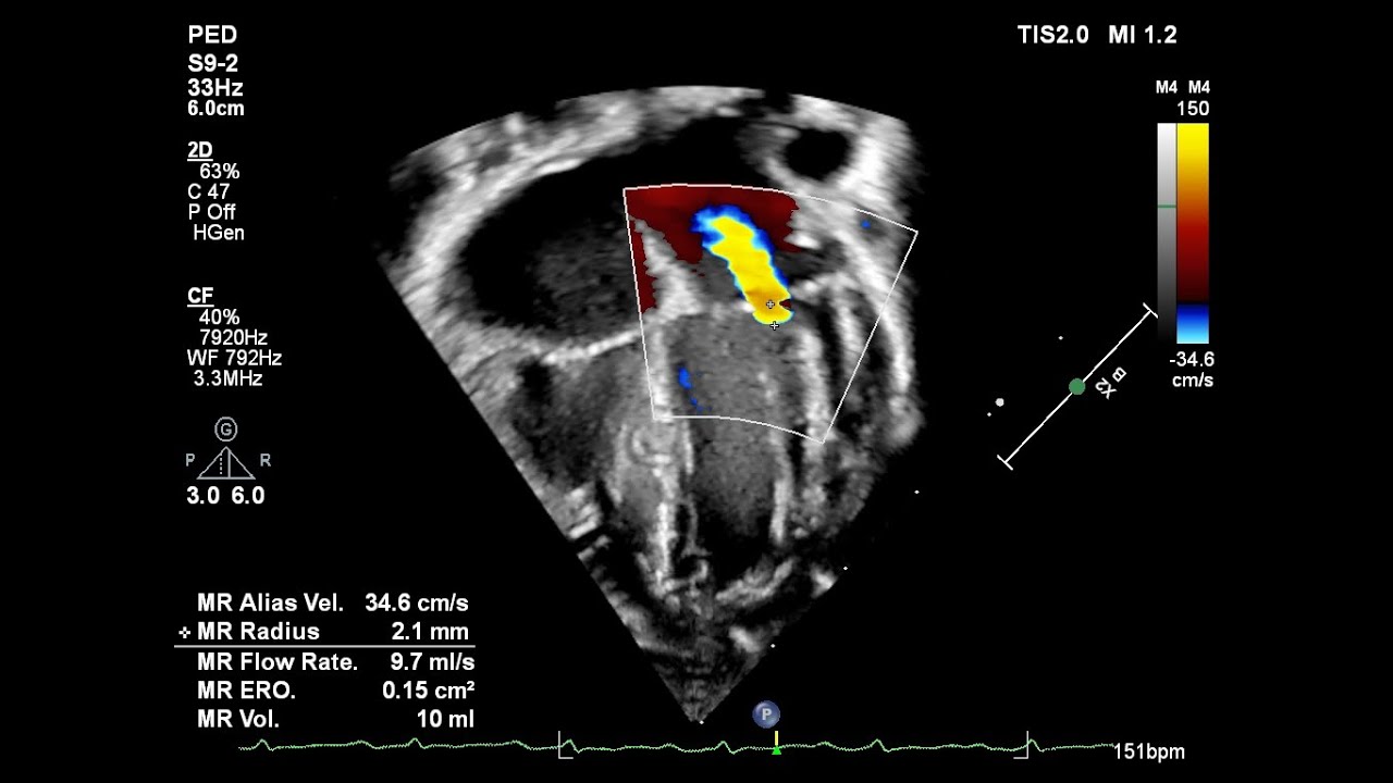 Basic echocardiography(심장 초음파 기본)- ALCAPA(Anomalous left coronary ...