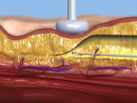 Body Tite UK Main Video @ The Northern Clinic (BodyTite / Body Tight ...