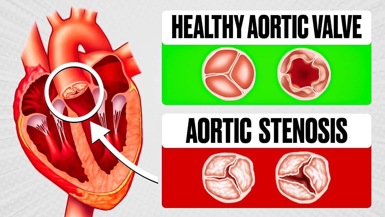 THESE first 4 symptoms - a sign of aortic stenosis! DON'T MISS THEM ...