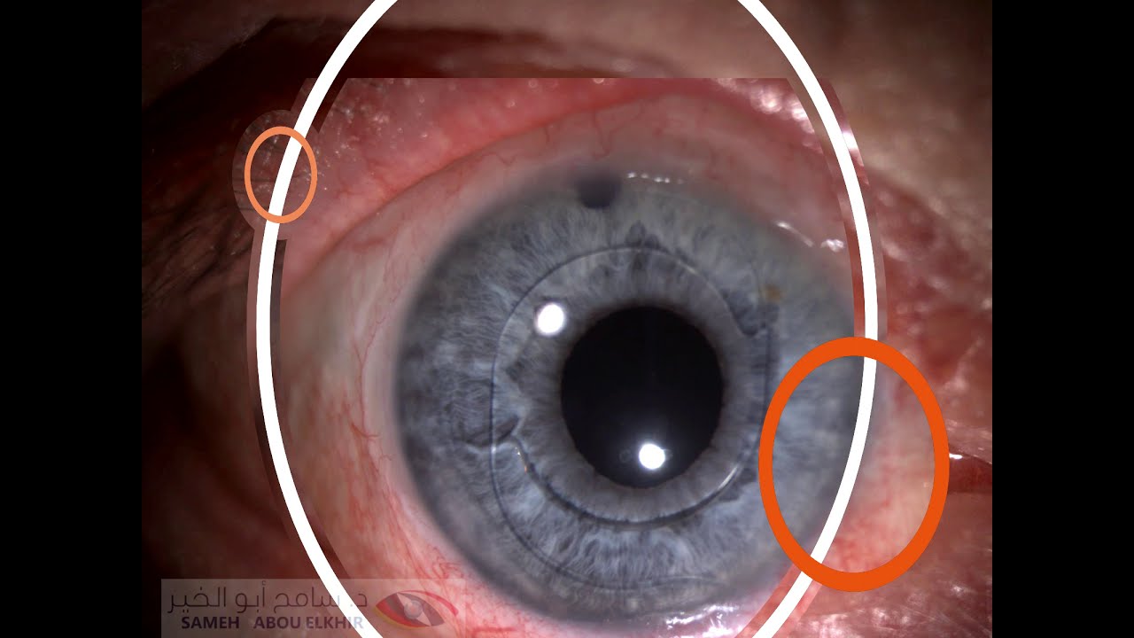 A-IOL Slit Lamp Examination - YouTube