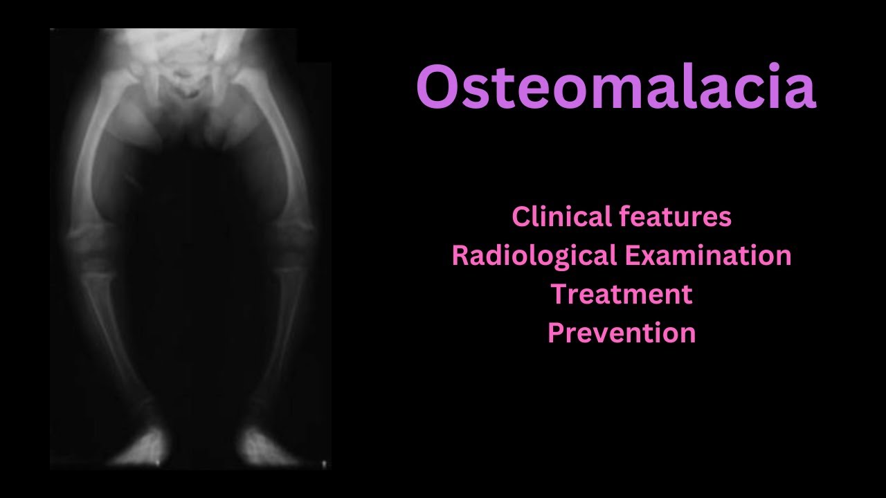 Osteomalacia: Causes, Clinical features, Radiological examination ...