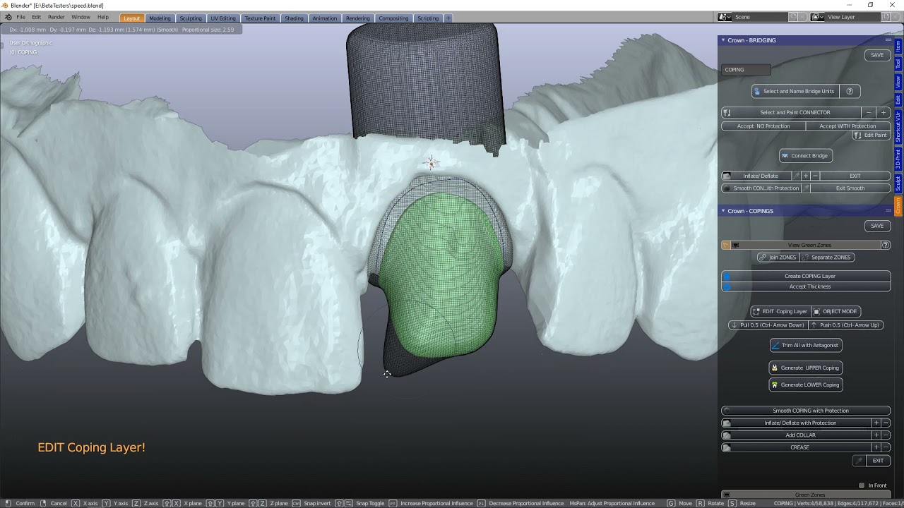 B4D Dental Modules- Crown Module - YouTube