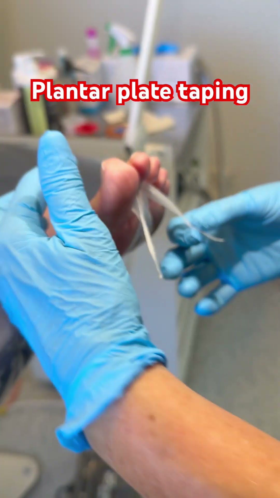 Plantar plate taping for partial tear . Following a platelet rich ...